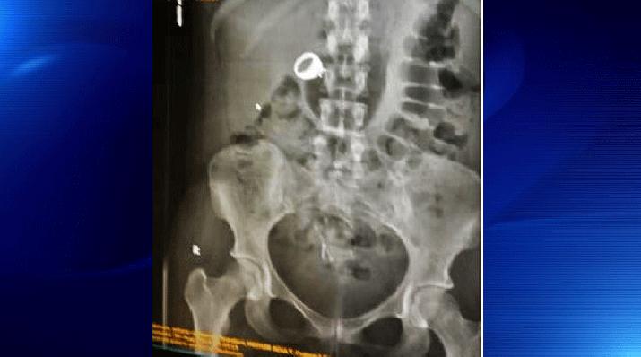 Police: Suspect Swallowed Stolen Diamond Ring | wusa9.com