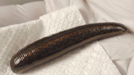Lovable leeches? Practitioner says therapeutic benefits outweigh the ...